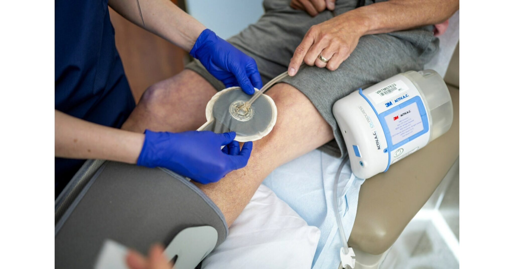 Wound Care / VAC Therapy – Dr Prashant Kumar